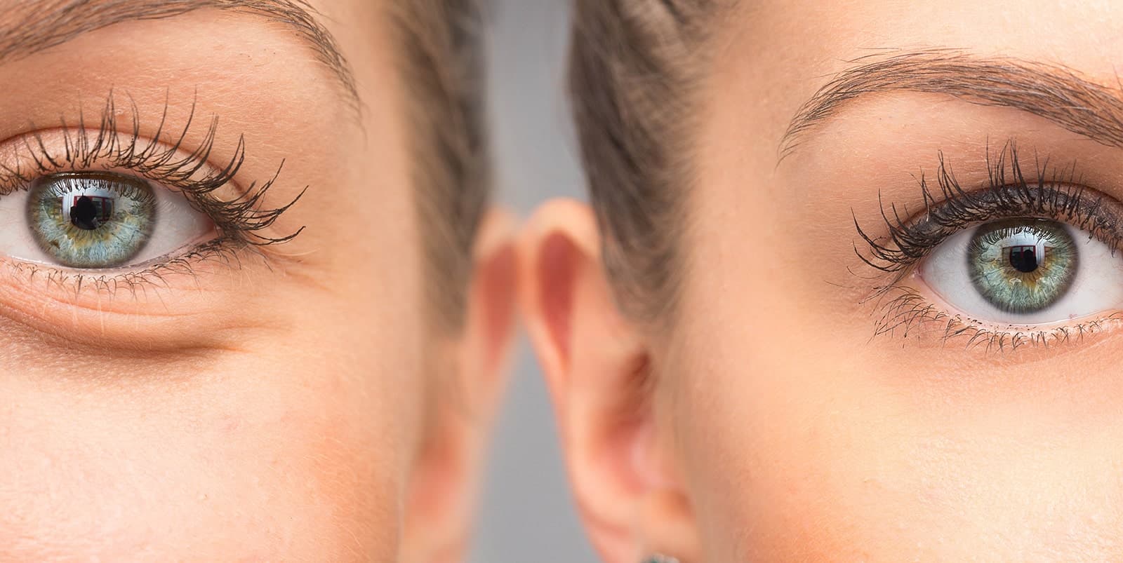 Blephex Treatment | Centers for Dry Eye